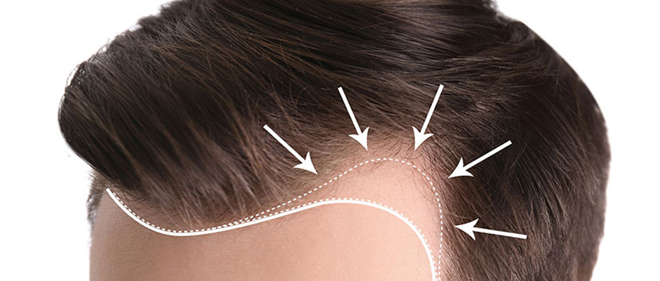 What To Expect On Fue Hair Transplant Surgery Day